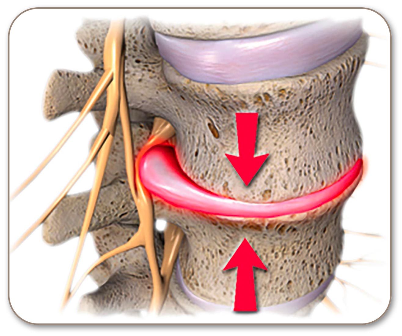 Traitement des vertèbres - Devenir Reactivopathe